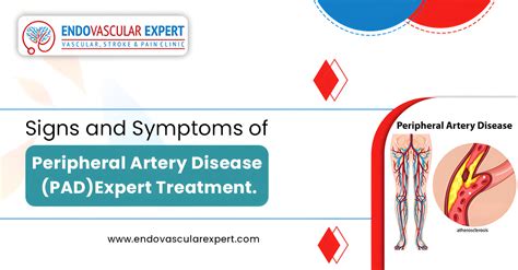 Symptoms Of Peripheral Artery Disease Pad Expert Treatment