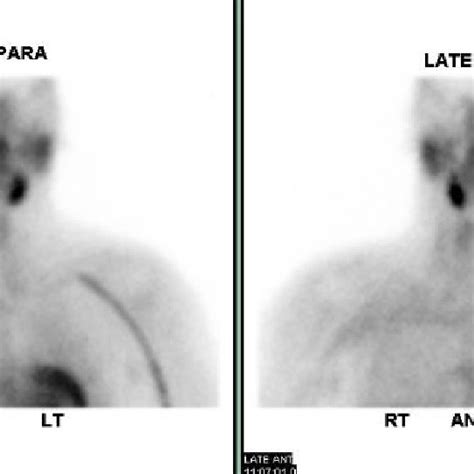 Sestamibi Scan Was Negative For Parathyroid Lesions Download