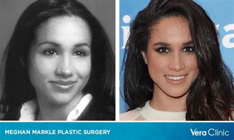 Meghan Markle Plastic Surgeries Before And After