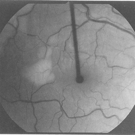 Retinal Cloudy Swelling Temporal To A Fixation Pointer Due To Occlusion