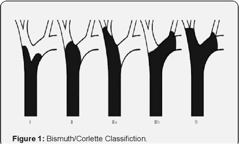 Figure 1 From A New Clinical Classification Of Hilar Cholangiocarcinoma