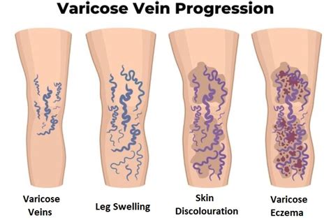 How Varicose Veins Affect The Skin The Vein Institute