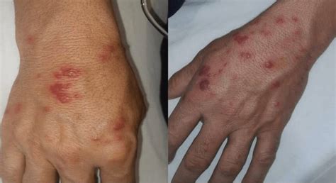 Rare Skin Manifestation Of Tularemia Sweet Syndrome Sbmt