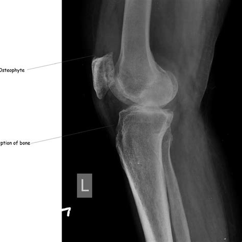 5 X Ray View Of The Knee Joint Showing Resorption Of Tibia And