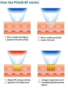 Pixel8 Rf Micro Needling Hideaway Iv And Aesthetics