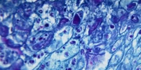 Cdc Announces Partnership With Labcorp To Increase Monkeypox Testing