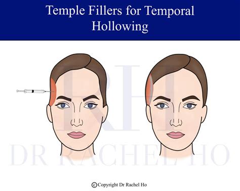 Temple Fillers For Hollow Temples Dr Rachel Ho