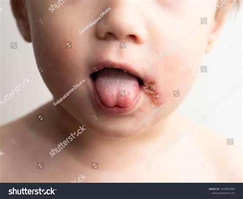 Stomatitis Simplex Symptome Stomatitis Symptoms Causes And