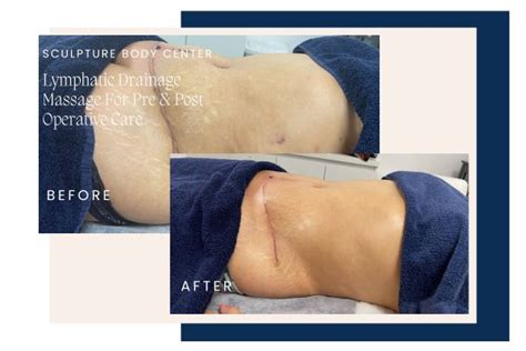 Lymphatic Drainage Massage Watertown Ma Pre And Post Operative Care
