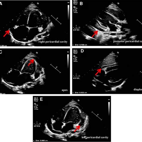 Echocardiography On Admission Showed Pericardial Effusion A Download Scientific Diagram