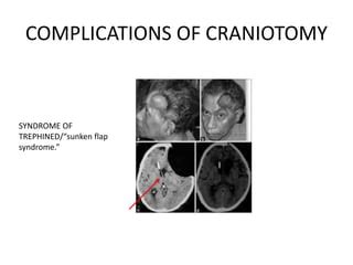 Care Of The Patient Following Craniotomy Pptx