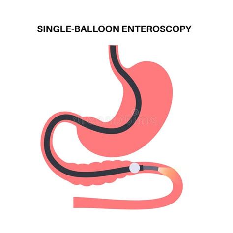 Single Balloon Enteroscopy Stock Vector Illustration Of Vector 290185145
