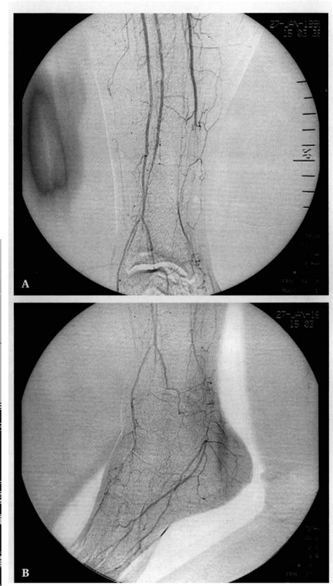 Figure 1 From Cannabis Arteritis Revisited Semantic Scholar