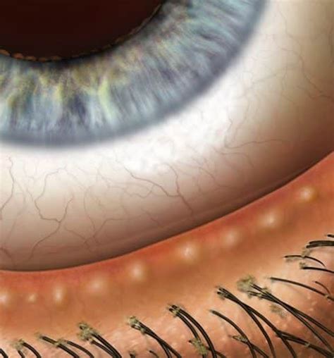 Blepharitis Eyelid Inflammation Seidenberg Protzko Eye Associates Maryland