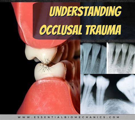 Understanding Occlusal Trauma