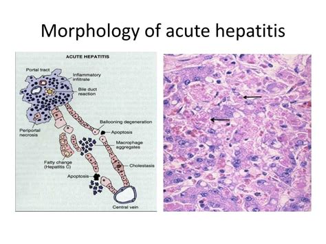 Interface Hepatitis Definition At Albina Giese Blog