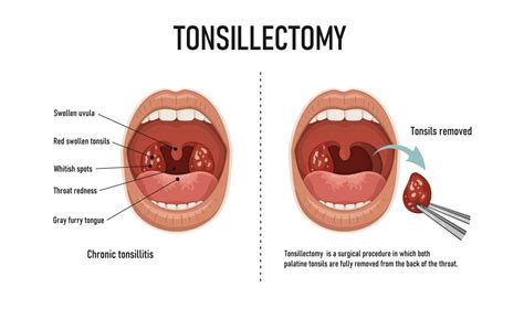 What You Need To Know About Tonsil And Adenoid Surgery Annapolis And