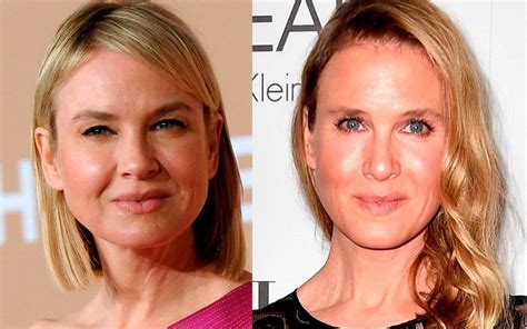 Celebrities Before And After Plastic Surgery Gone Wrong 60 Photos
