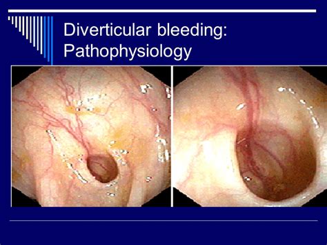 Diverticular Disease Of The Colon Ppt Download