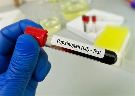 Premium Photo Pepsinogen I And Ii For The Diagnosis For Early