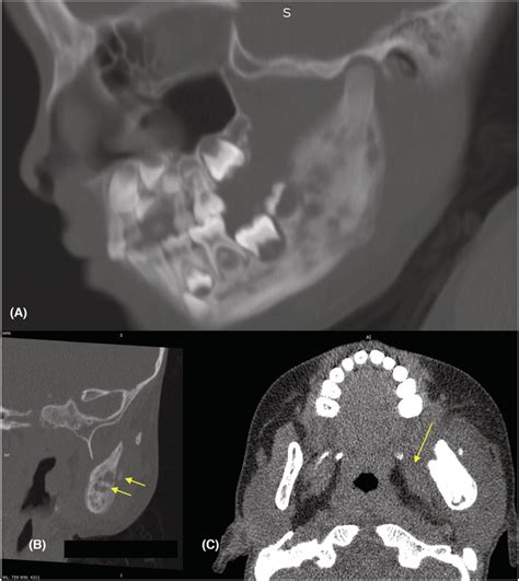 A Sagittal View Showing The Spread Of The Lesion To The Condyle B