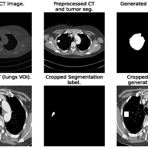 Illustrated Example Of Data Preprocessing With Corresponding Lung Voi