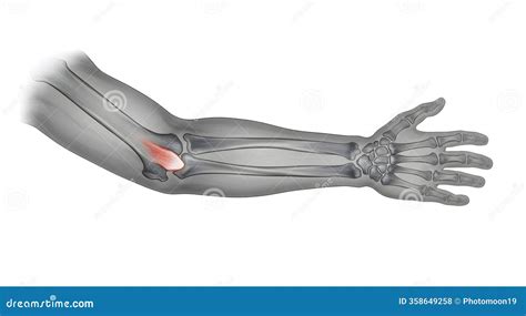 Fracture Forearm Bones Osteoporosis Icon Doodle Illustration