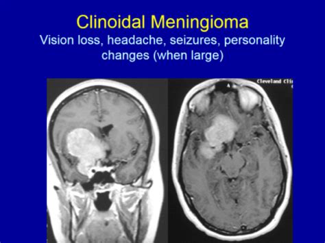 Clinical Presentation And Radiographic Appearance By Location Valley