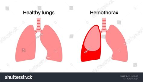 Hemothorax Disease Blood Collects Pleural Cavity Stock Vector Royalty