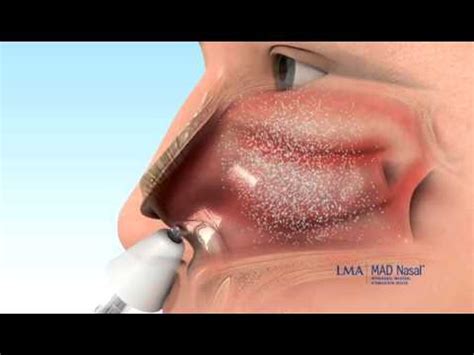 Lma Nasal Mucosal Atomization Device Mad140 Live Action Safety