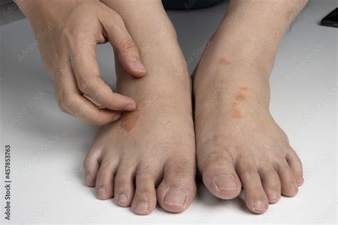 Hand Scratching Foot Infected By Ringworm Athletes Foot Or Tinea