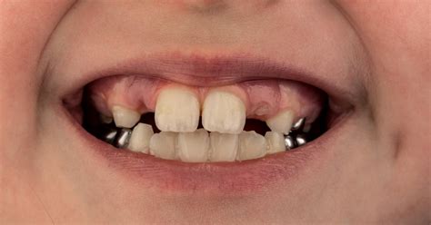 Congenitally Missing Teeth