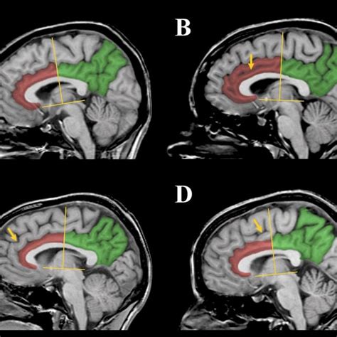 PDF Anatomical Variability Of The Anterior Cingulate Gyrus And Basic Dimensions Of Human