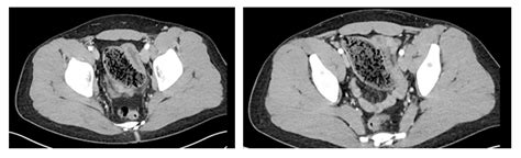 Food Bolus Ileus As A Cause Of High Grade Bowel Obstruction A Case Report