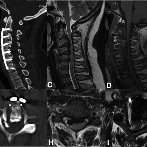 Radiologic Data Of Case 1 A Preoperative Sagittal Ct Scan Showed Download Scientific Diagram