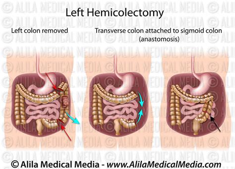 Alila Medical Media Left Hemicolectomy Medical Illustration
