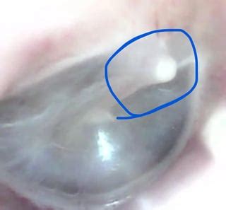 What Is This White Dot On My Eardrum Rmedical