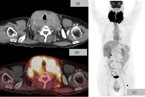 A C Fused Axial Pet And Ct Images Shows Diffuse Uptake In Thyroid Gland