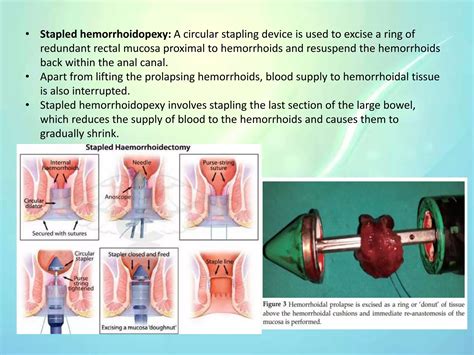 Quick Review On Hemorrhoids Pptx