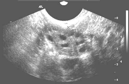 Abnormal Pelvic Transvaginal Ultrasound Results Transvaginal