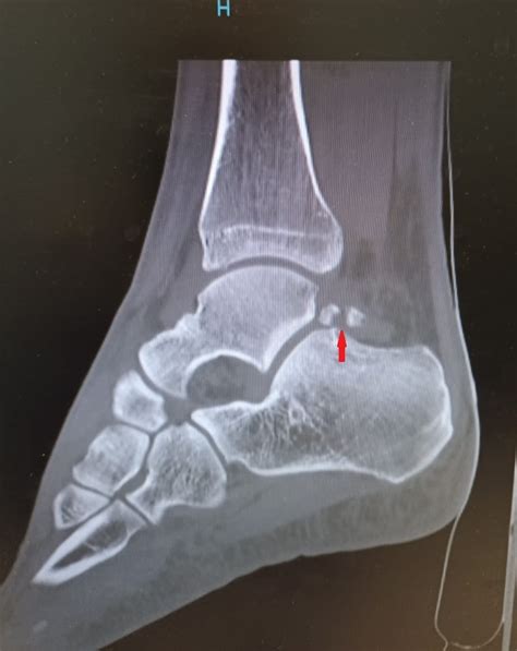 Fracture De Los Trigone La Revue Du Praticien