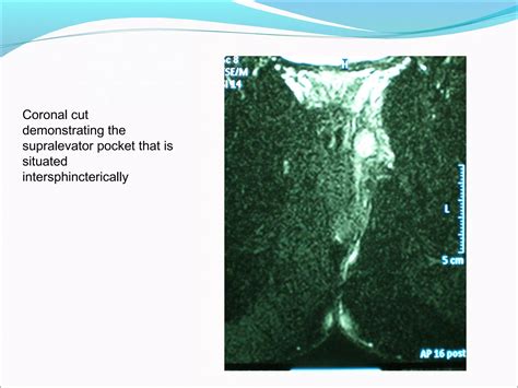 Postanal Space Fistula Ppt