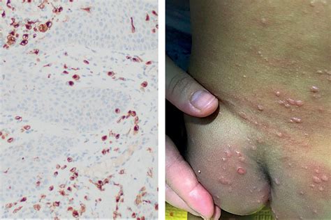 32 Facts About Pyelitis