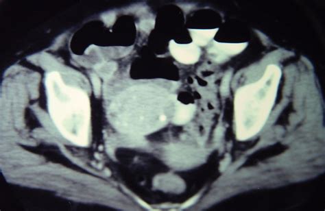 Small Bowel Tumor Gist 4039 Pictures 016 Surgery Photos