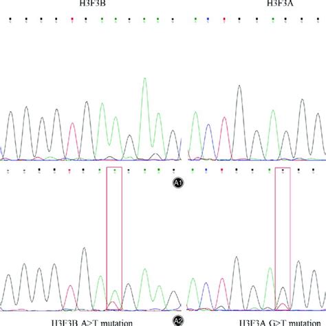 Weinstein Boriani Biagini Wbb Classification Is Divided Into 12