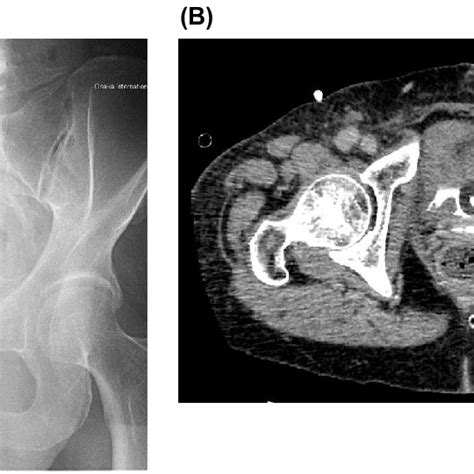 Pretreatment Imaging Results A Ct Cystogram The Leakage Of Contrast