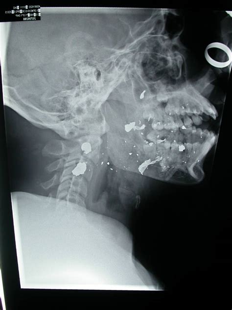 Trauma Face Buyxraysonline
