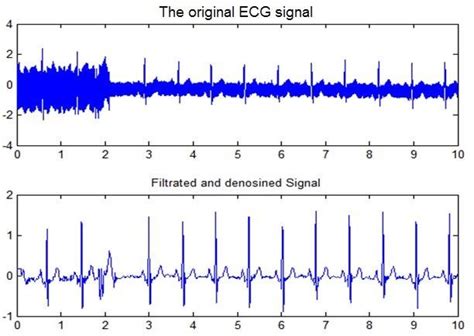 The Ecg Signal Before And After Filtration And Denoising Download
