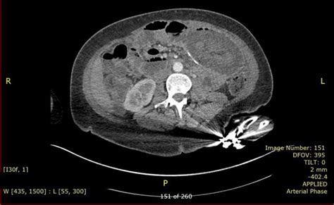 Cect Showed The Concentric Ring Sign Download Scientific Diagram