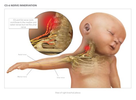 Tampa Brachial Plexus Birth Injury Attorneys